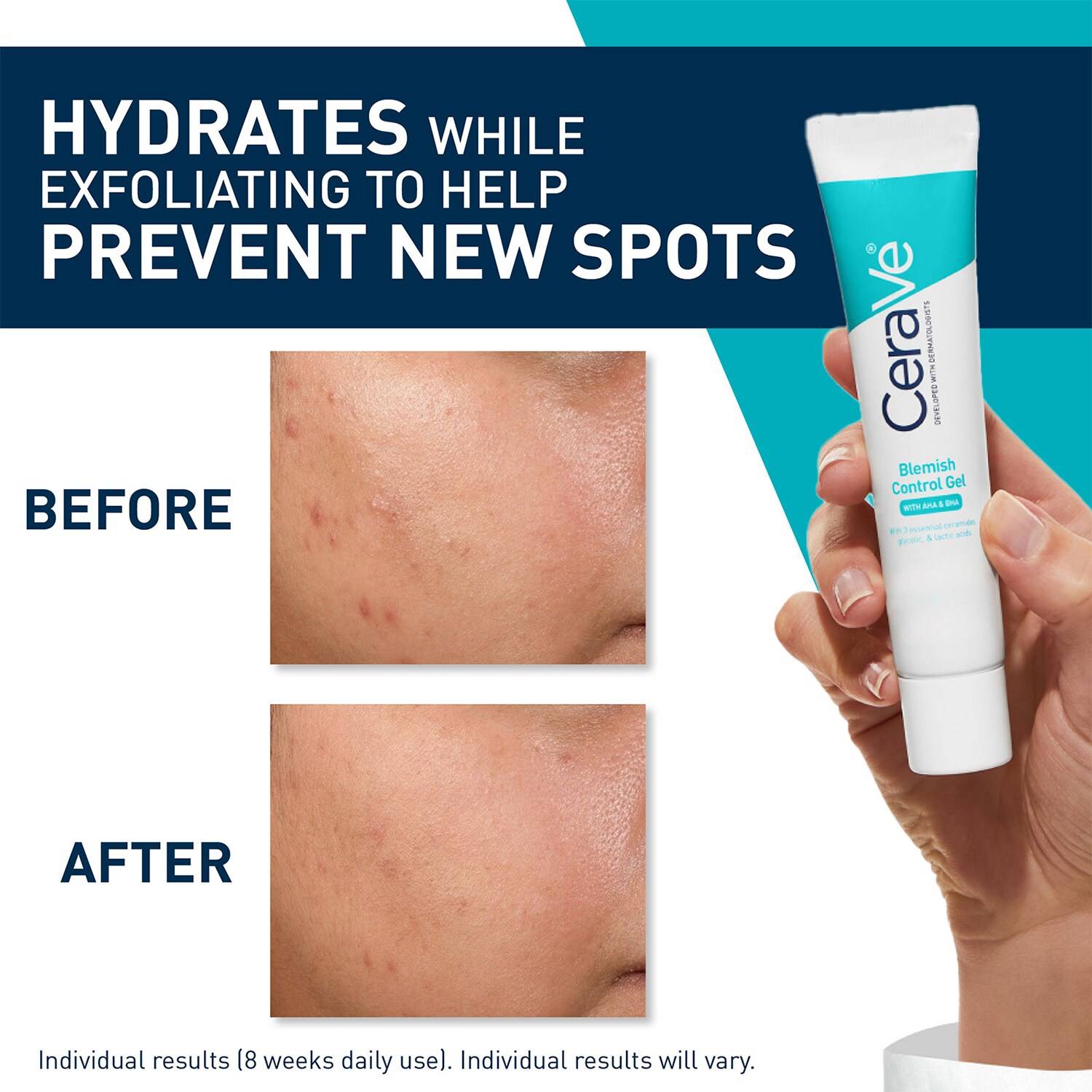 CeraVe Blemish Control Gel Moisturiser with 2% Salicylic Acid ...